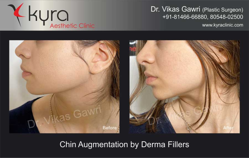 Chin augmentation - Cosmetic Surgery in Ludhiana, Plastic Surgery in ...