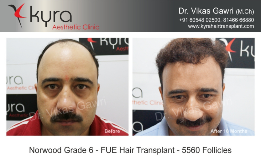 Hair Transplant in Ludhiana, Punjab Cosmetic Surgeon in Ludhiana, Punjab
