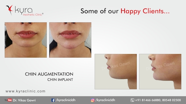 Chin Implant in Ludhiana, Punjab, India