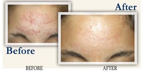 Laser for Burn Scar Surgery in Ludhiana, Punjab, India
